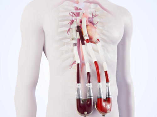 Berlin Heart Today Announces CE Approval and First Implantation of an ...